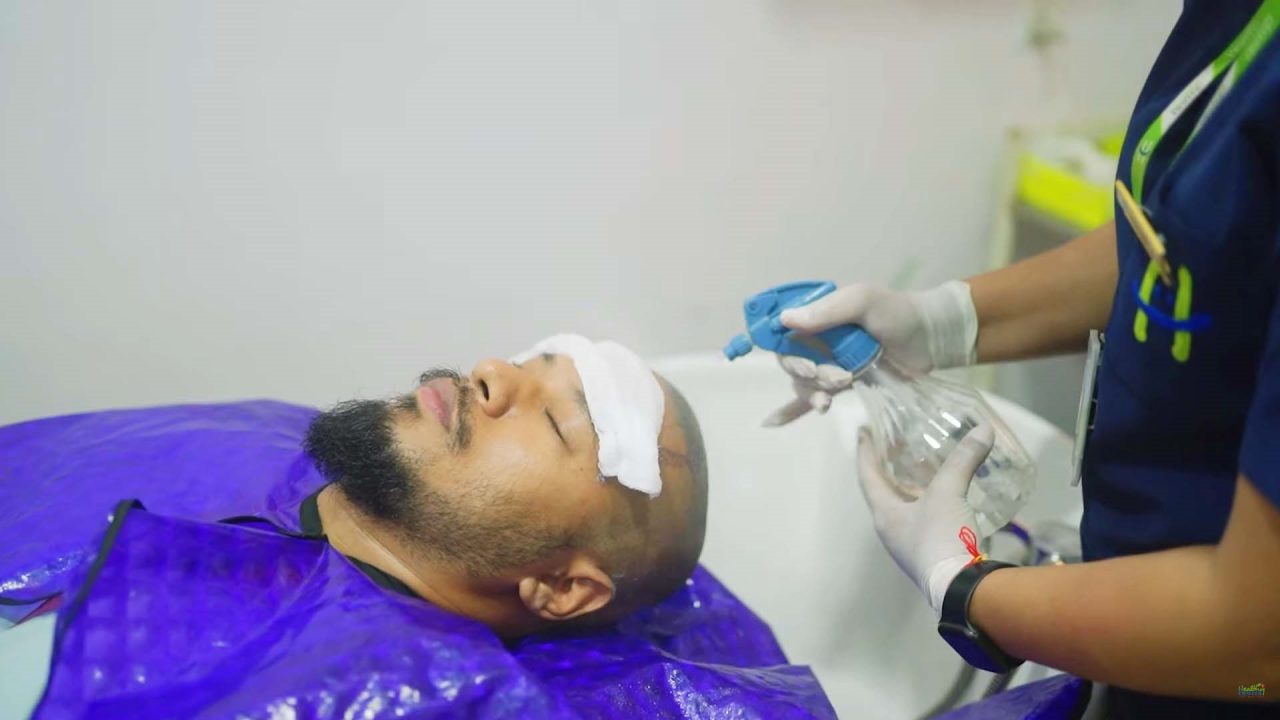 Hair Transplantation Journey of Manoj KC | Healthy Choice