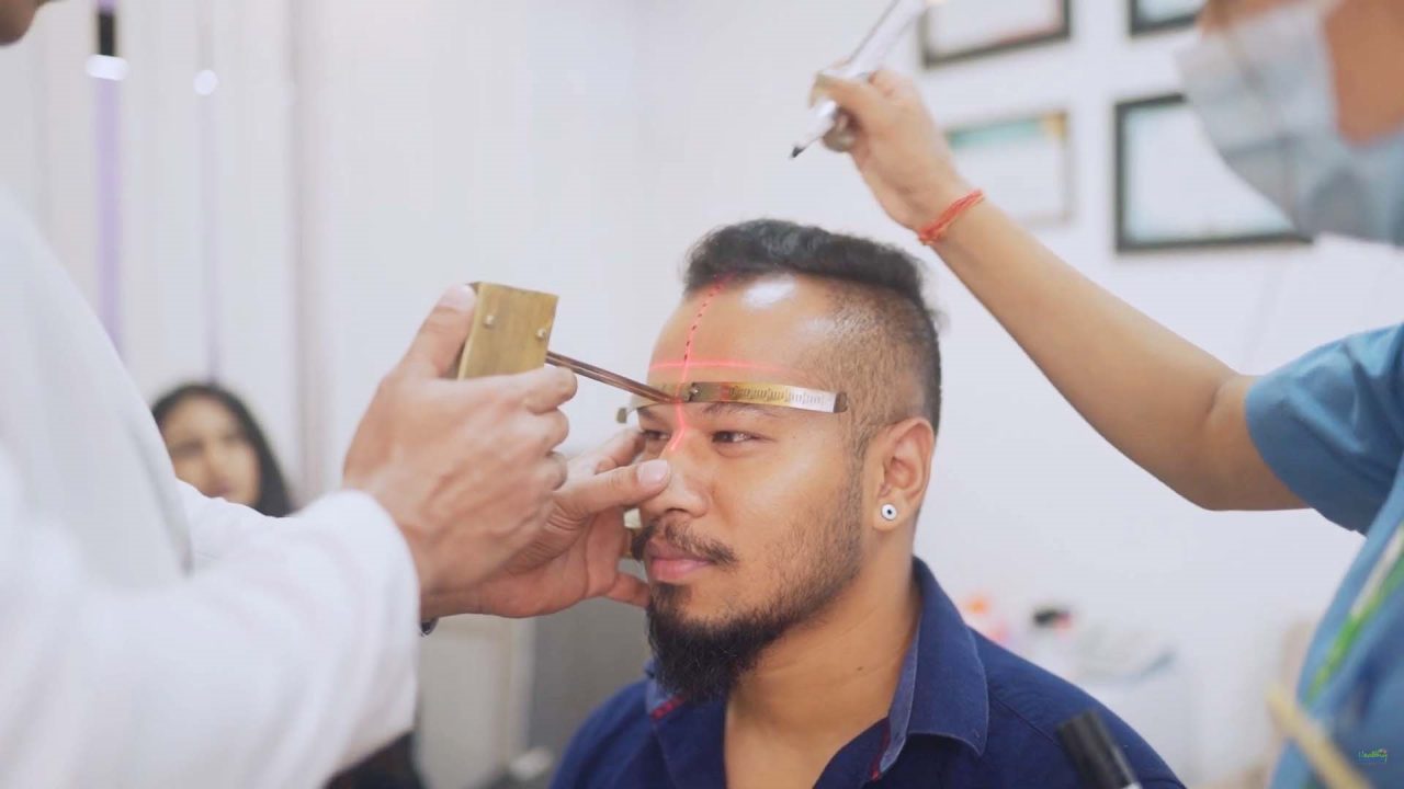 Hair Transplantation Journey of Manoj KC | Healthy Choice