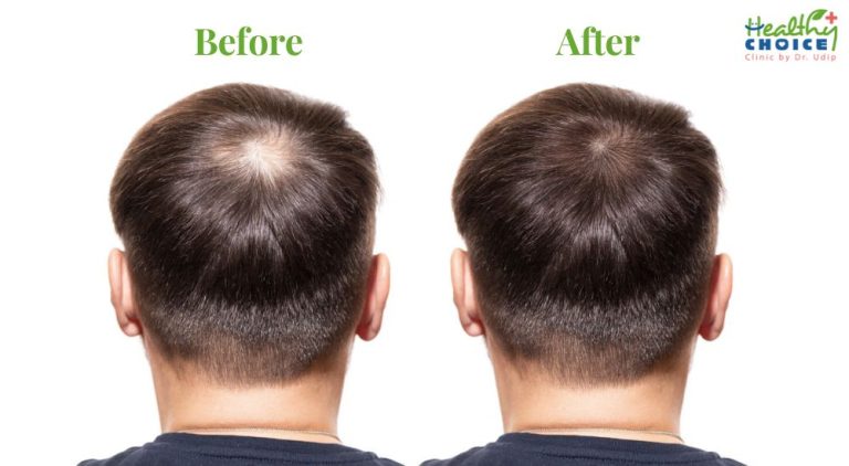 GFC Hair Treatment | Natural Hair Regrowth