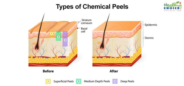 Chemical Peeling in Nepal | Price in Nepal | Healthy Choice Aesthetic ...