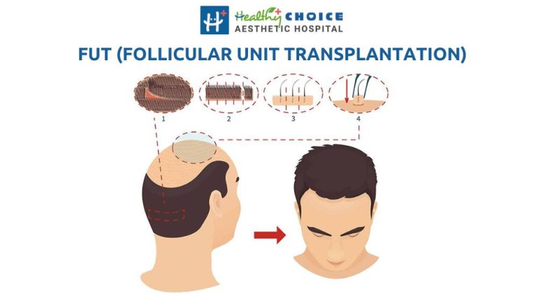 Best Hair Transplant in Nepal | Advanced Direct Hair Transplant
